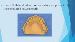 Diagnosis and Treatment Planning for Partially Edentulous Patient